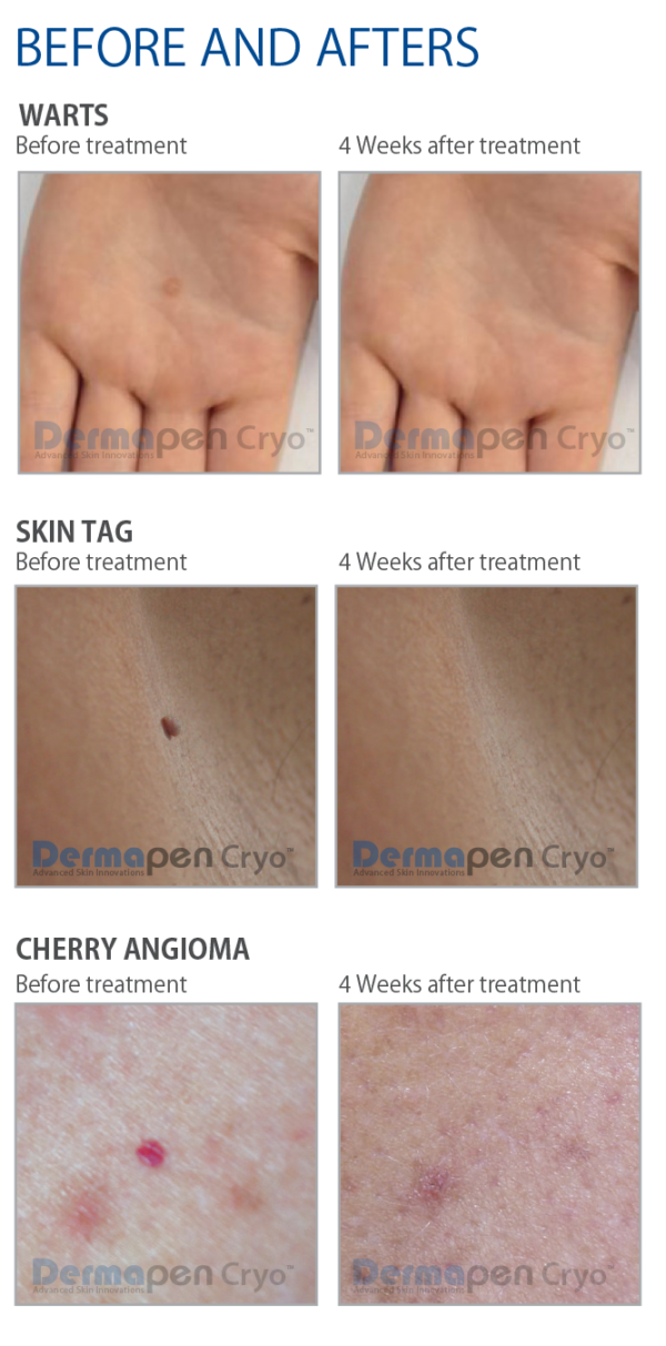 Cryo Pen | Microneedling | Star Spa Uptown